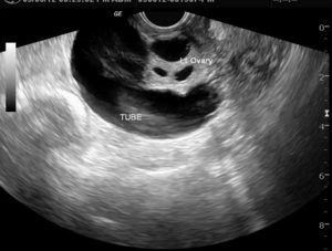Hydrosalpinx Ultrasound - SONOSIF - by SIFSOF, California