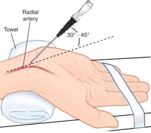 Colocación de línea arterial radial guiada por ultrasonido - SONOSIF ...