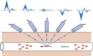 Speed and Direction of Blood flow - Doppler Ultrasound - SONOSIF - by ...