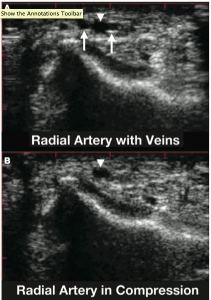 Ultrasound-guided Radial Arterial Line Placement - SONOSIF - by SIFSOF ...