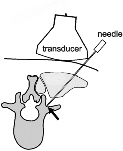 Ultrasound-Guided Facet Nerve Block - SONOSIF - by SIFSOF, California