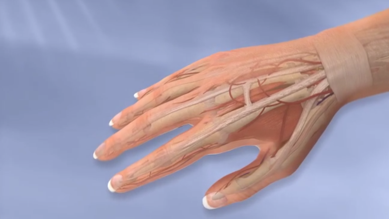 Ultrasound-guided Wrist Arthroscopy - SONOSIF - by SIFSOF, California